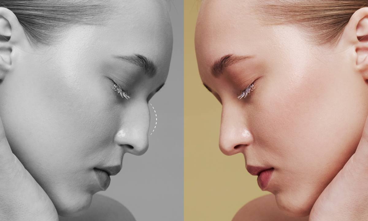 Rhinoplasty Cost Explained: What Affects the Price of a Nose Job ...